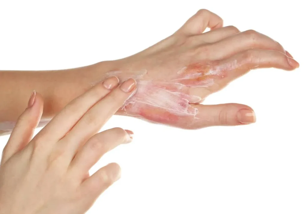 Burn Wound Care: Degrees, Treatment & Advanced Dressings